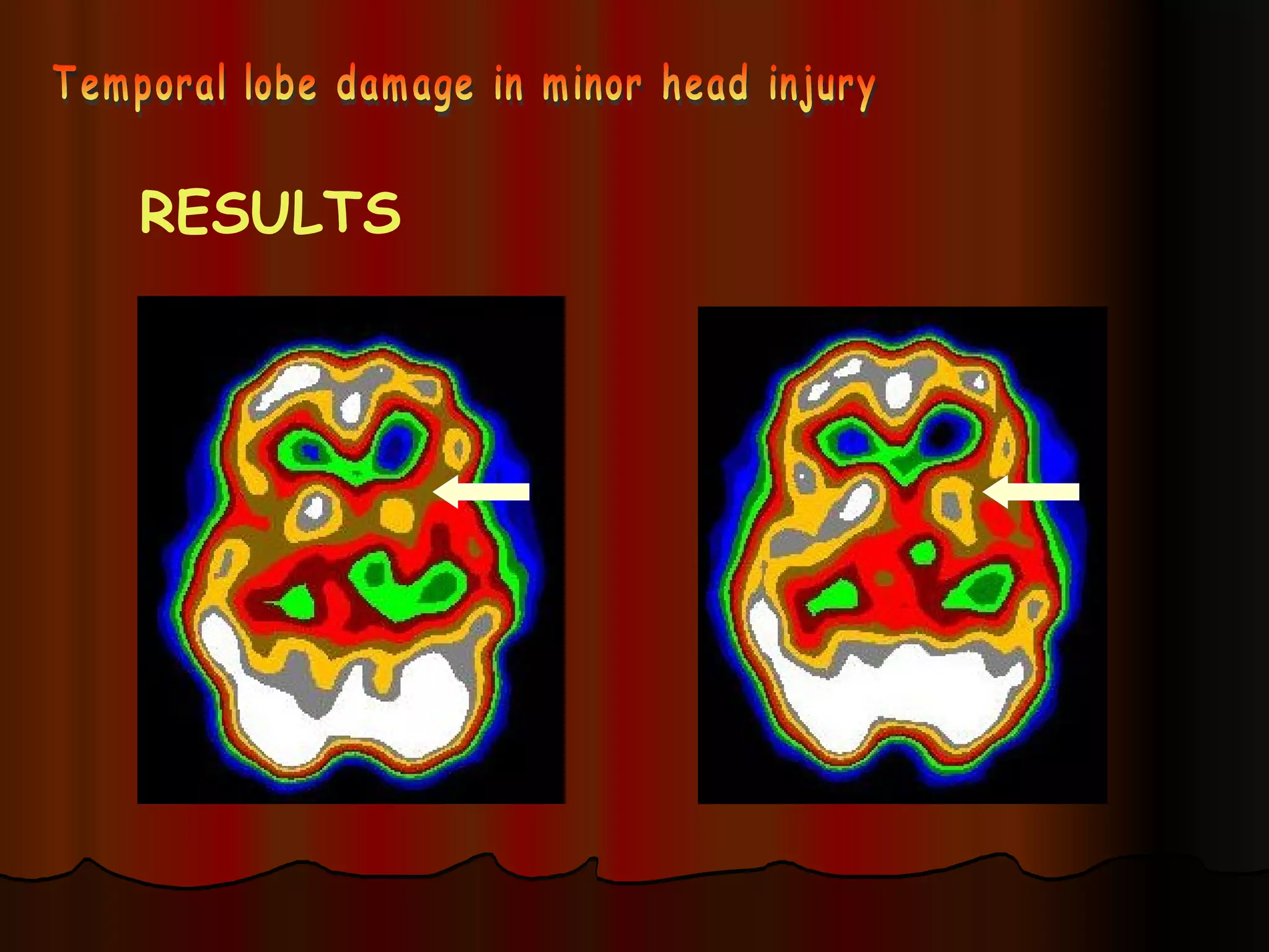 Minor head injury & medial temporal damage | PPT
