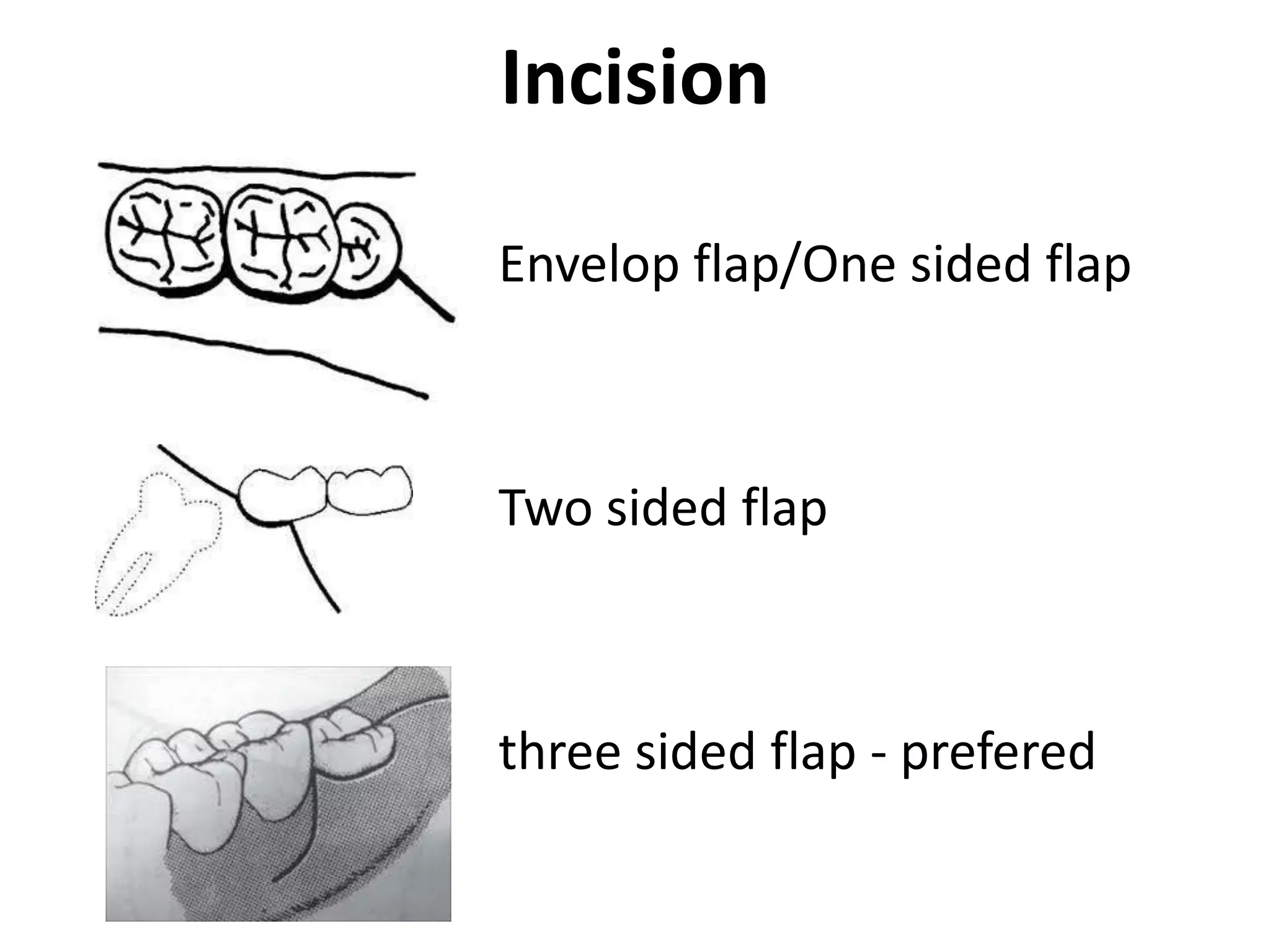 Mandibular impacted third molar removal | PPTX