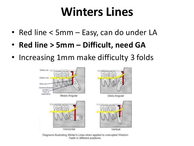 Mandibular impacted third molar removal