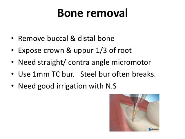 Mandibular impacted third molar removal