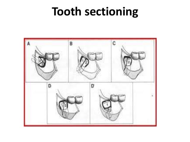 Mandibular impacted third molar removal