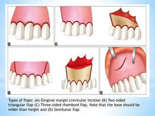 minor oral surgical procedures final.pptx