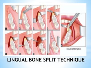 minor oral surgical procedures final.pptx