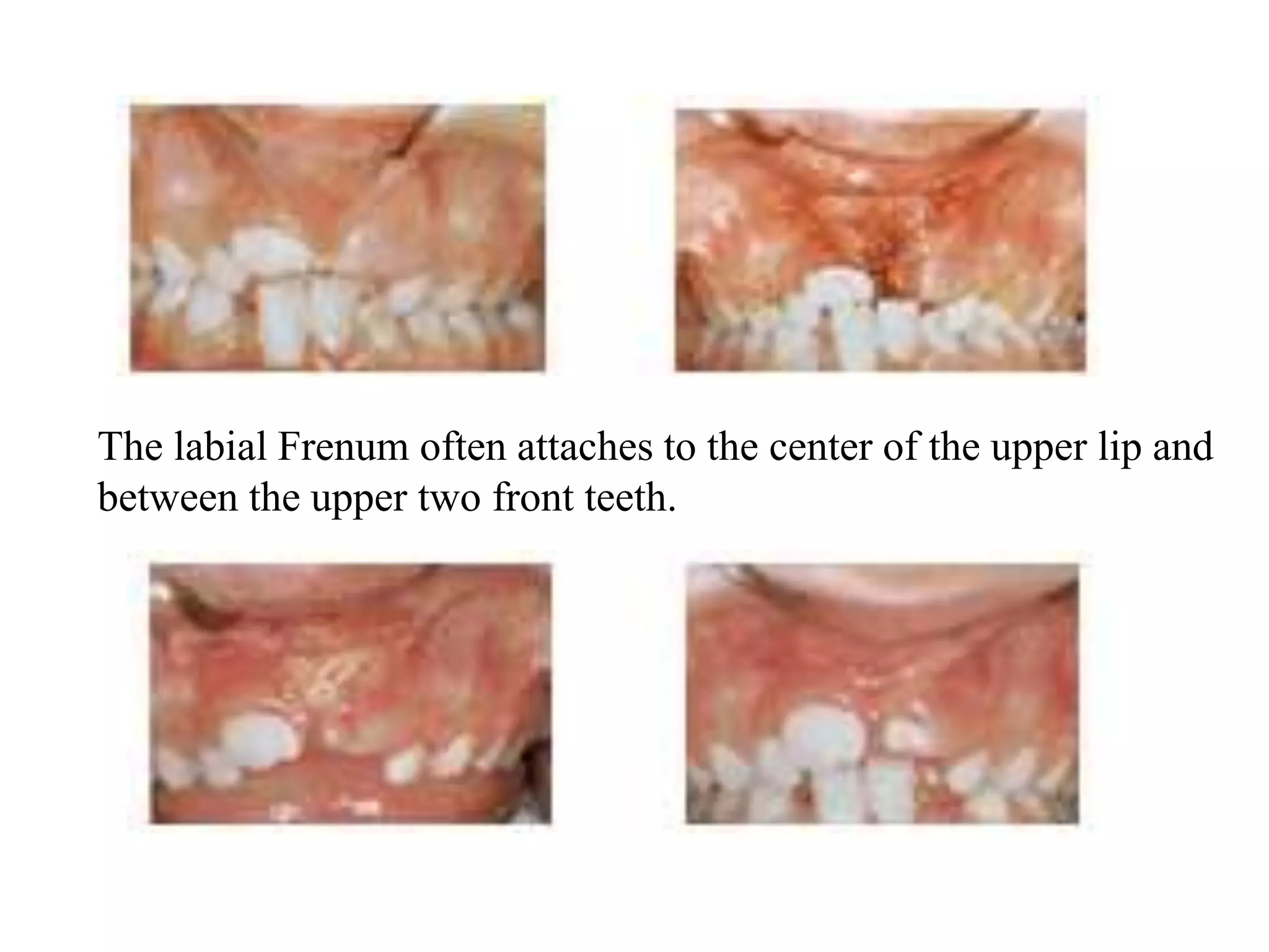 Minor oral Surgical Procedures in Children.ppt