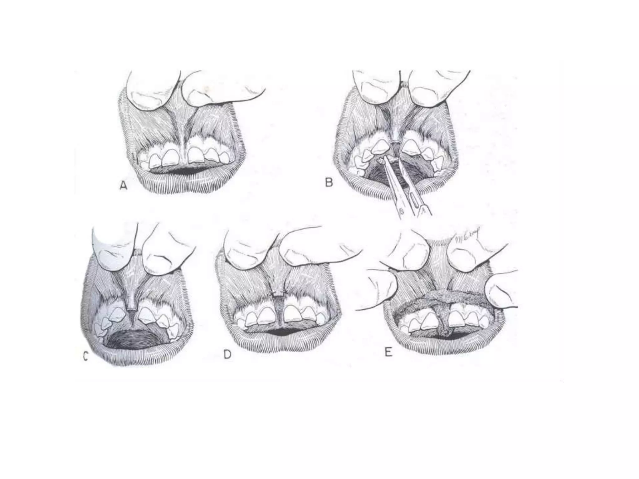 Minor oral Surgical Procedures in Children.ppt