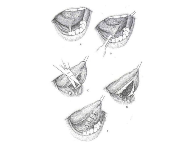 Minor oral Surgical Procedures in Children.ppt | Ear, Nose and Throat ...