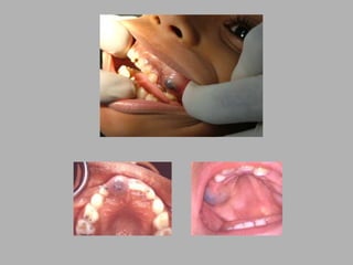 Minor oral Surgical Procedures in Children.ppt