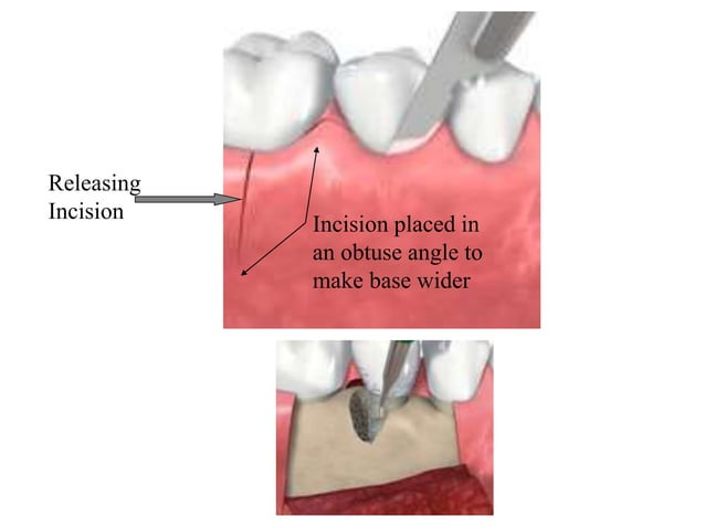 Minor oral Surgical Procedures in Children.ppt | Ear, Nose and Throat ...