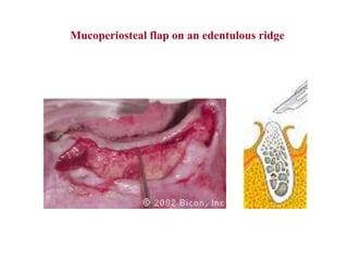 Minor oral Surgical Procedures in Children.ppt