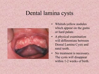 Dental Lamina Cyst