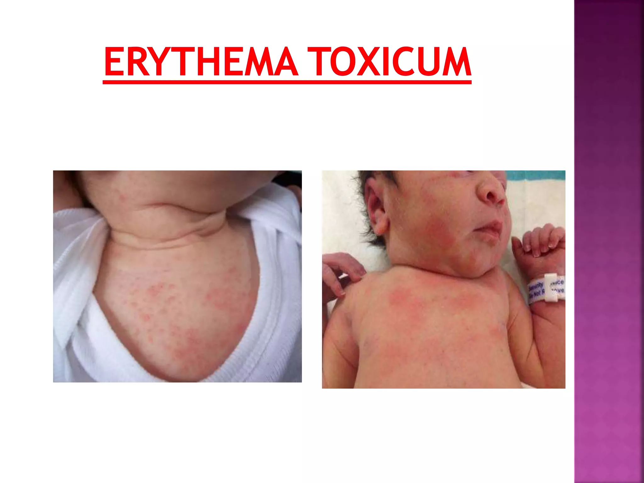 Common neonatal problems | PPTX