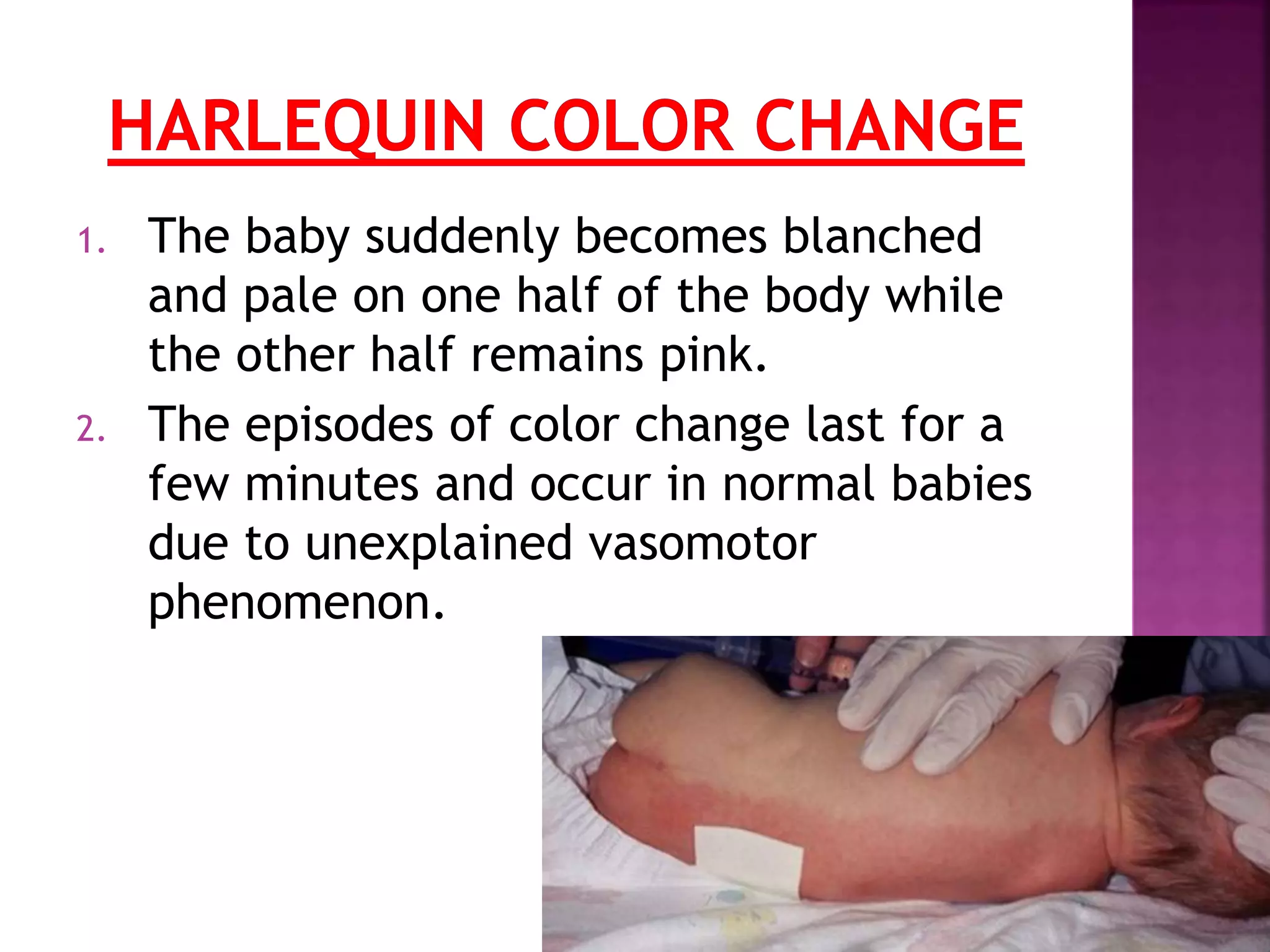 Common neonatal problems | PPTX