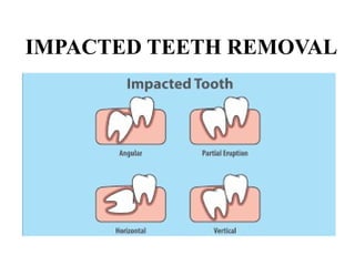 Minor oral surgical procedure associated with oral surgery | PPTX