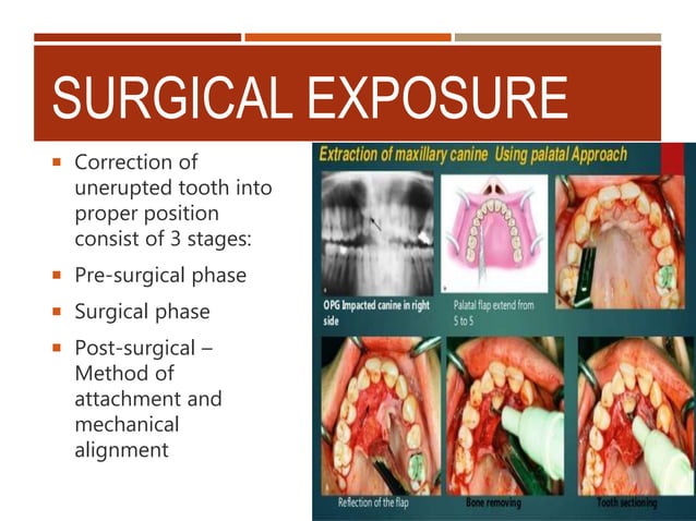 Minor surgical procedures in Orthodontics | PPTX | Dental Health ...