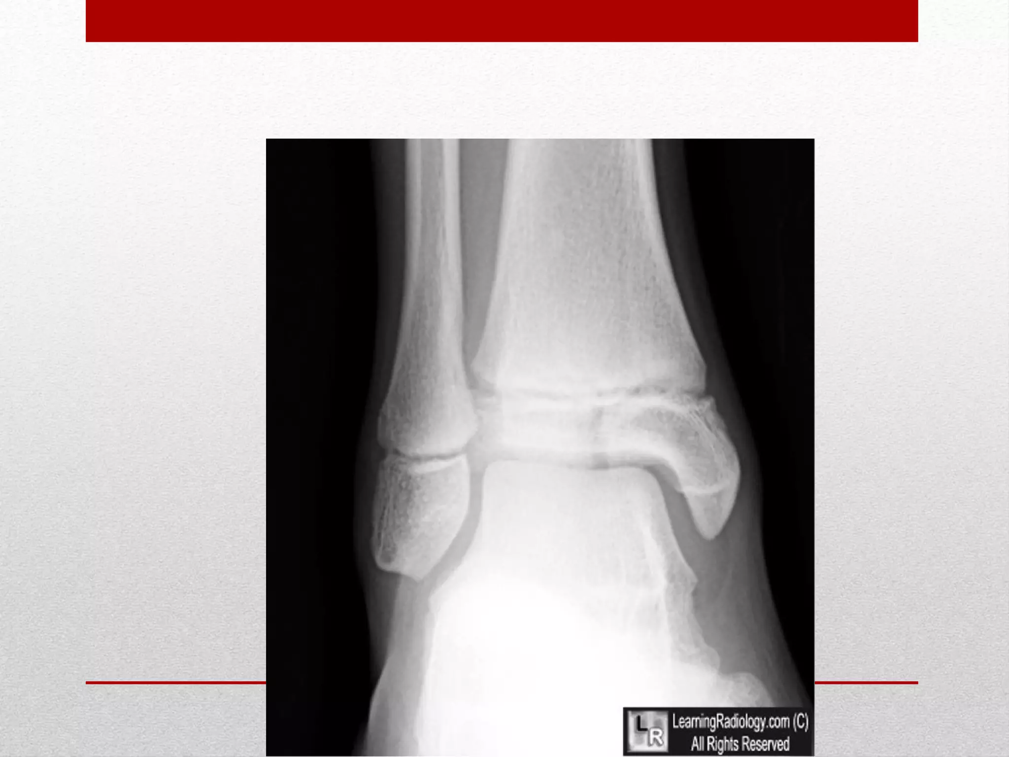 Paediatric Minor Trauma | PPT