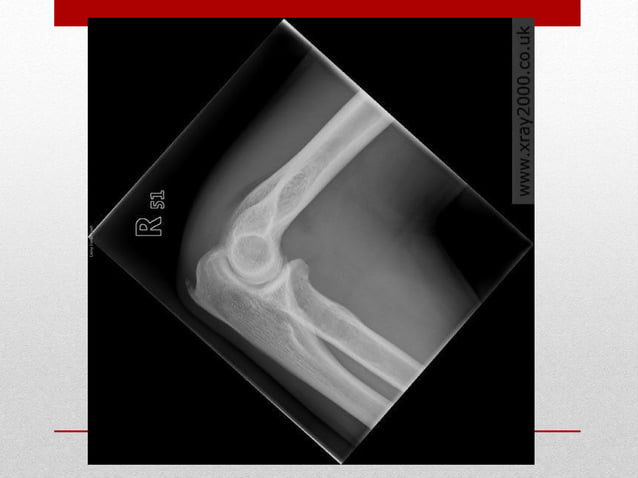 Paediatric Minor Trauma | PPT