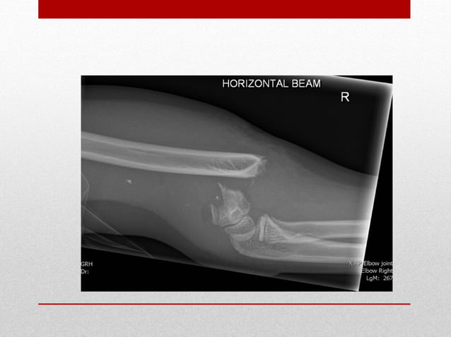Paediatric Minor Trauma | PPT