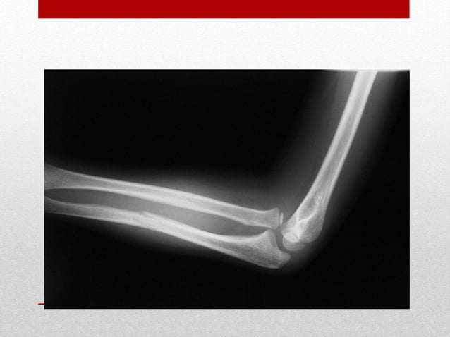 Paediatric Minor Trauma | PPT