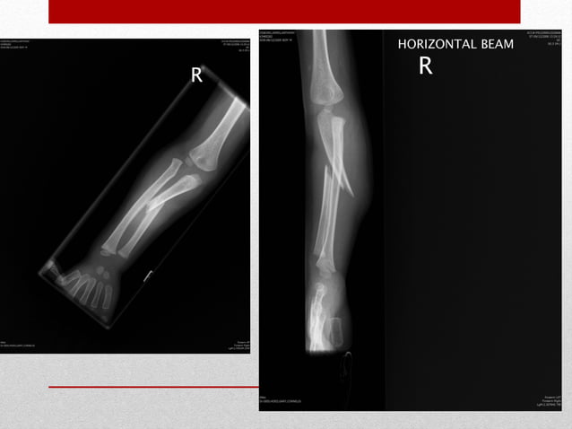 Paediatric Minor Trauma | PPT