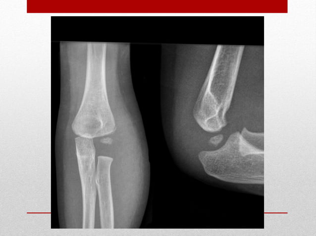 Paediatric Minor Trauma | PPT
