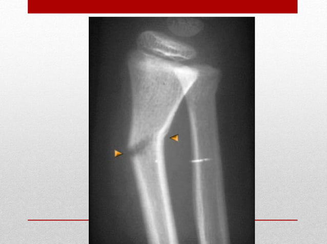 Paediatric Minor Trauma | PPT