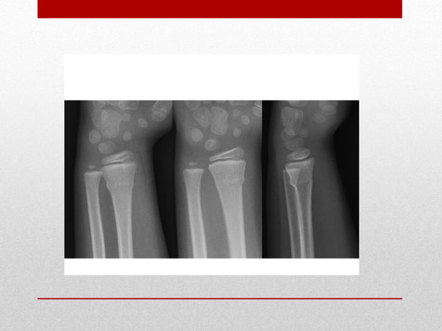 Paediatric Minor Trauma | PPT