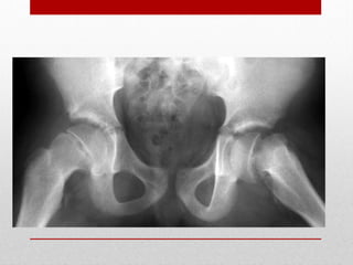 Paediatric Minor Trauma | PPT