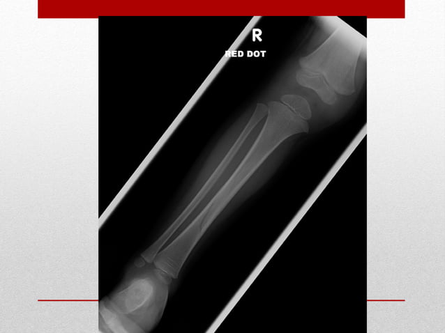 Paediatric Minor Trauma | PPT