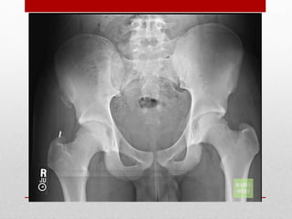 Paediatric Minor Trauma | PPT