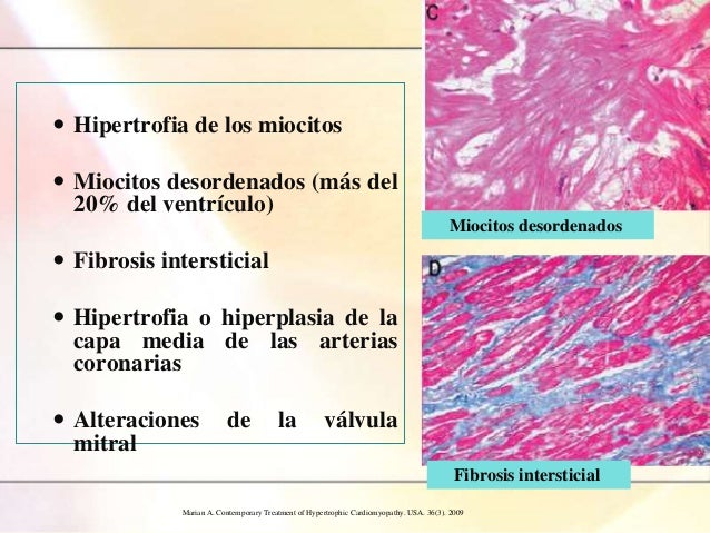 Miocardiopatia hipertrofica