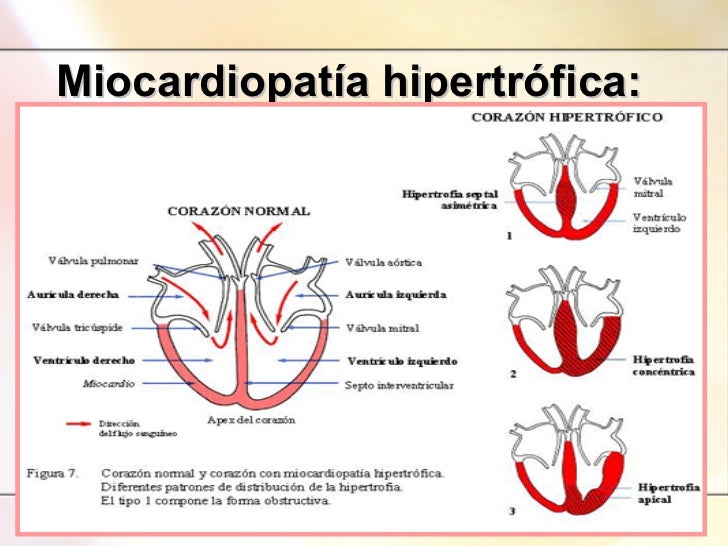 MIOCARDIOPATIAS