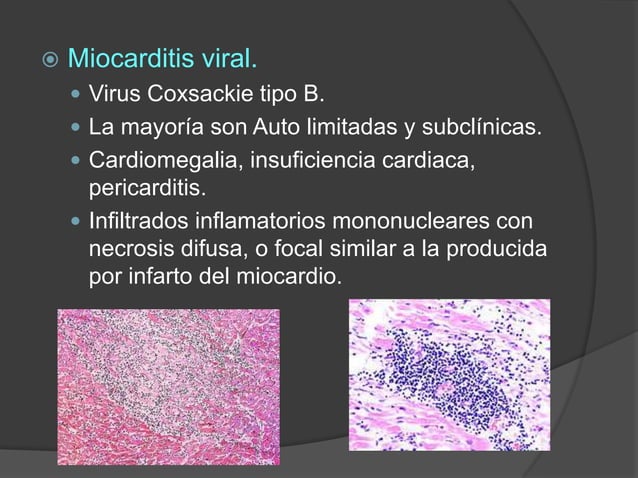 Miocarditis 3322