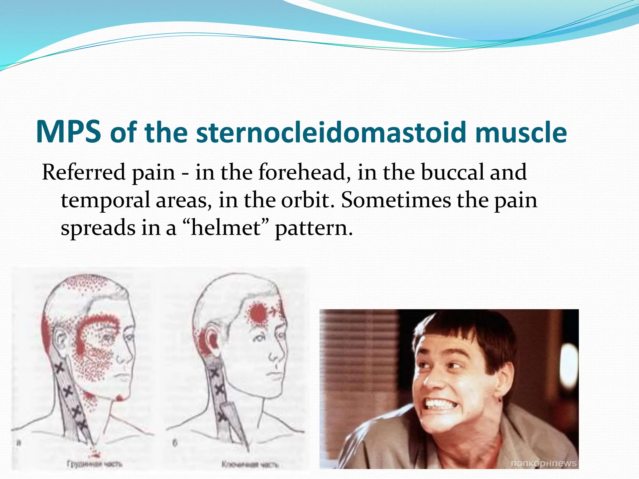 myofascial pain syndrome ENG pptttt.pptx