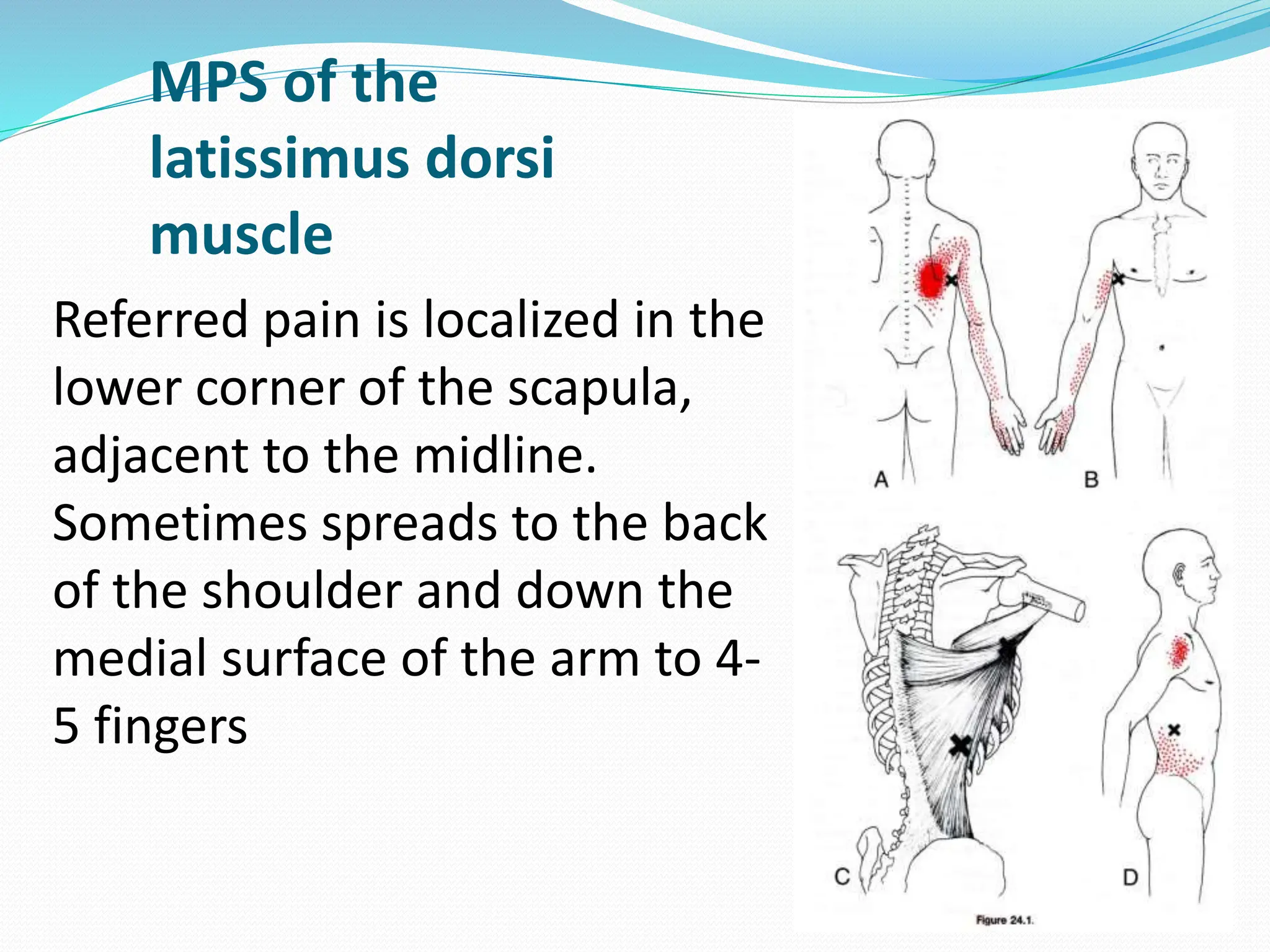 myofascial pain syndrome ENG pptttt.pptx