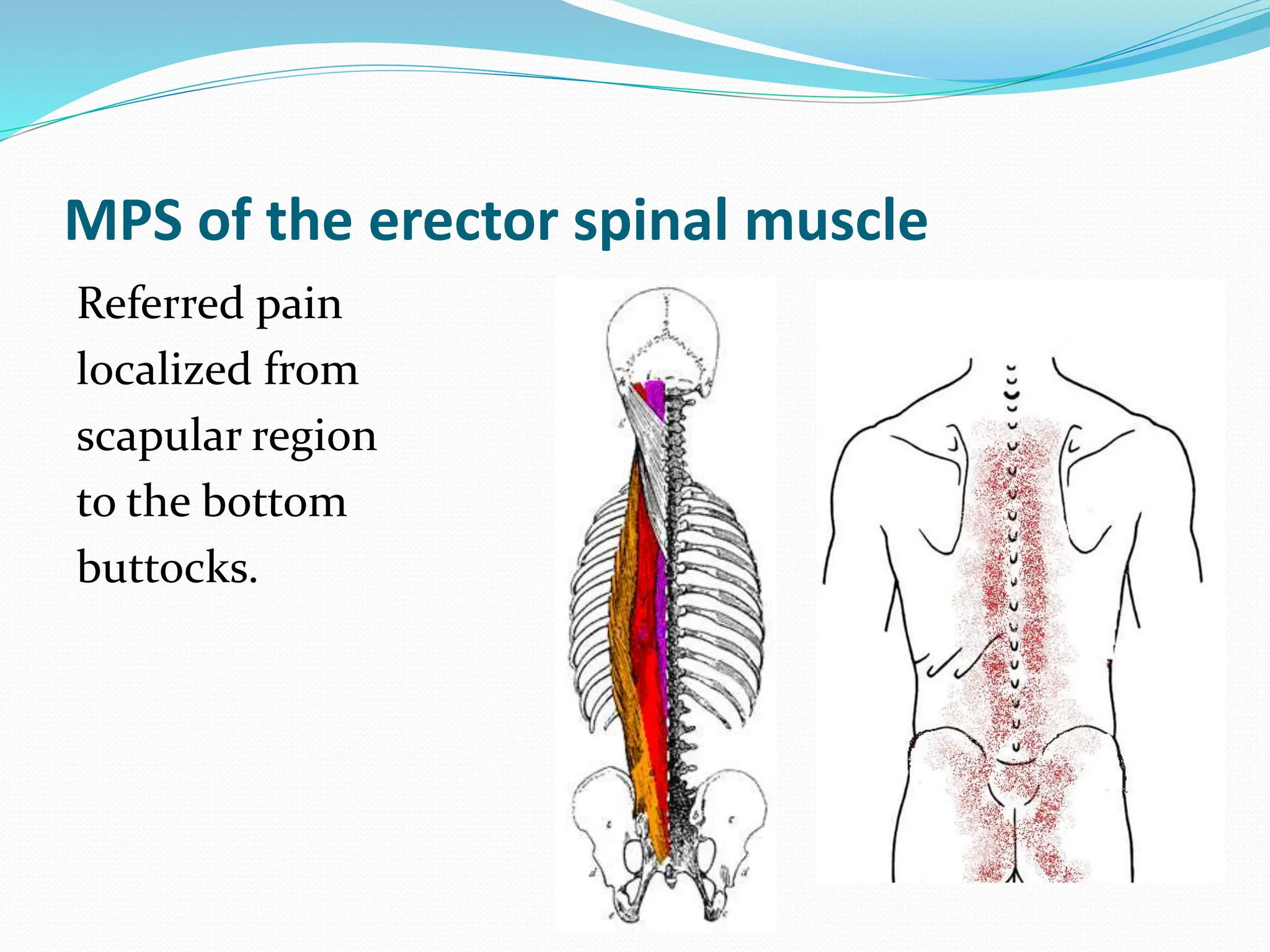 myofascial pain syndrome ENG pptttt.pptx