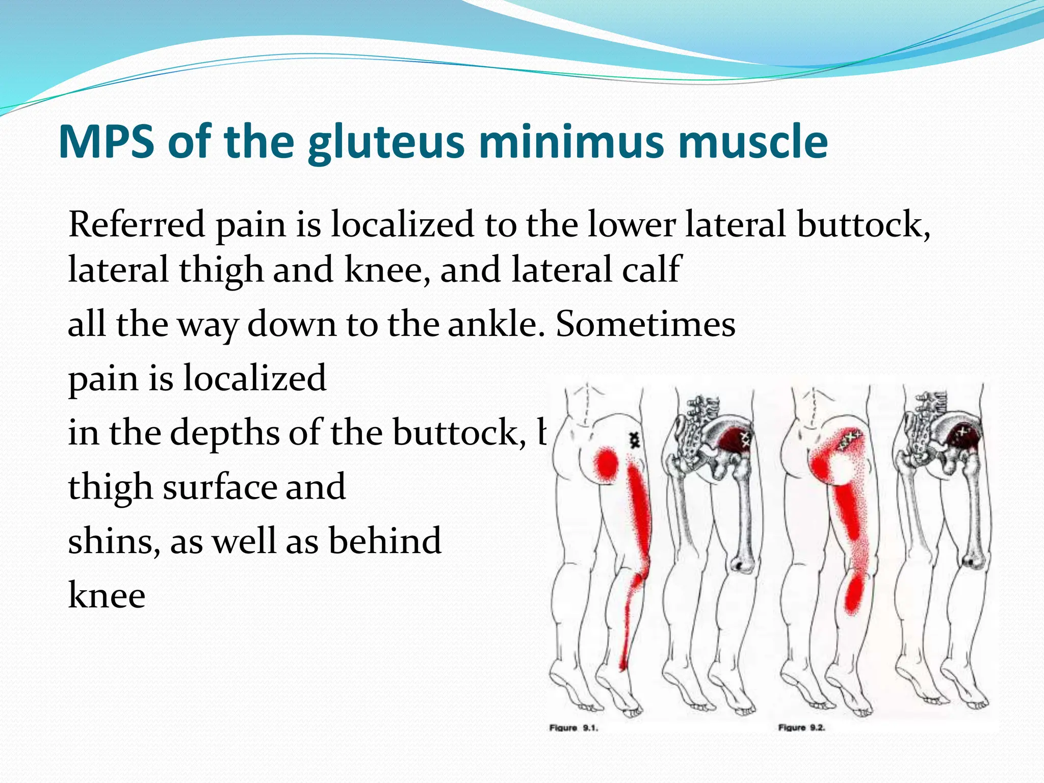 myofascial pain syndrome ENG pptttt.pptx