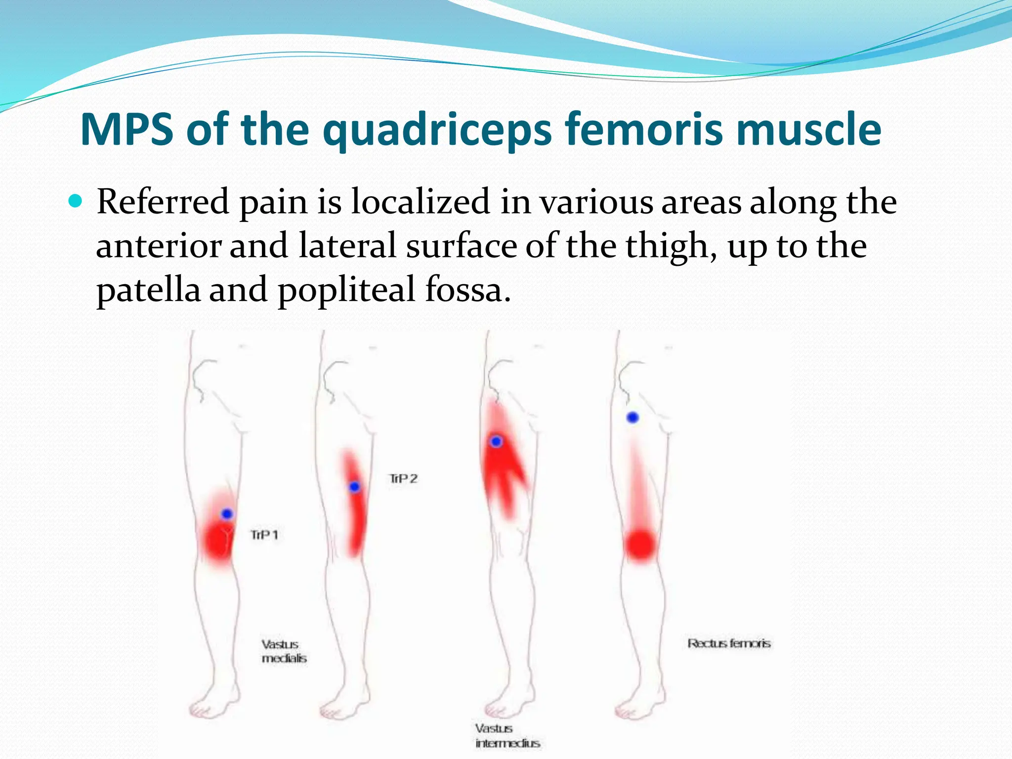 myofascial pain syndrome ENG pptttt.pptx