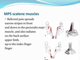 myofascial pain syndrome ENG pptttt.pptx