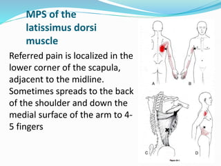 myofascial pain syndrome ENG pptttt.pptx
