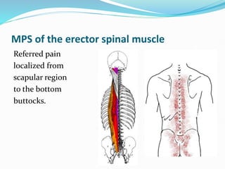 myofascial pain syndrome ENG pptttt.pptx