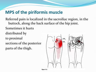 myofascial pain syndrome ENG pptttt.pptx