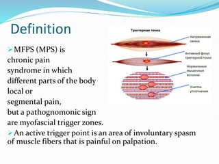 myofascial pain syndrome ENG pptttt.pptx