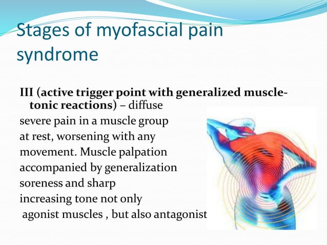 myofascial pain syndrome ENG pptttt.pptx | Death, Injury, or Military Conflict | Sensitive Topics