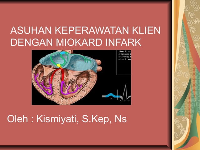 Miokard infark | PPT