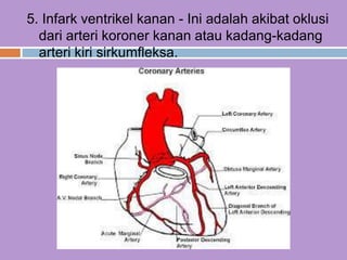 Miokard infark | PPTX
