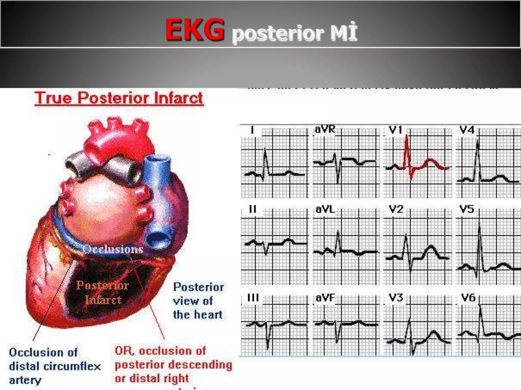Miokard infarkti (Myocardia infarctus) | PPTX