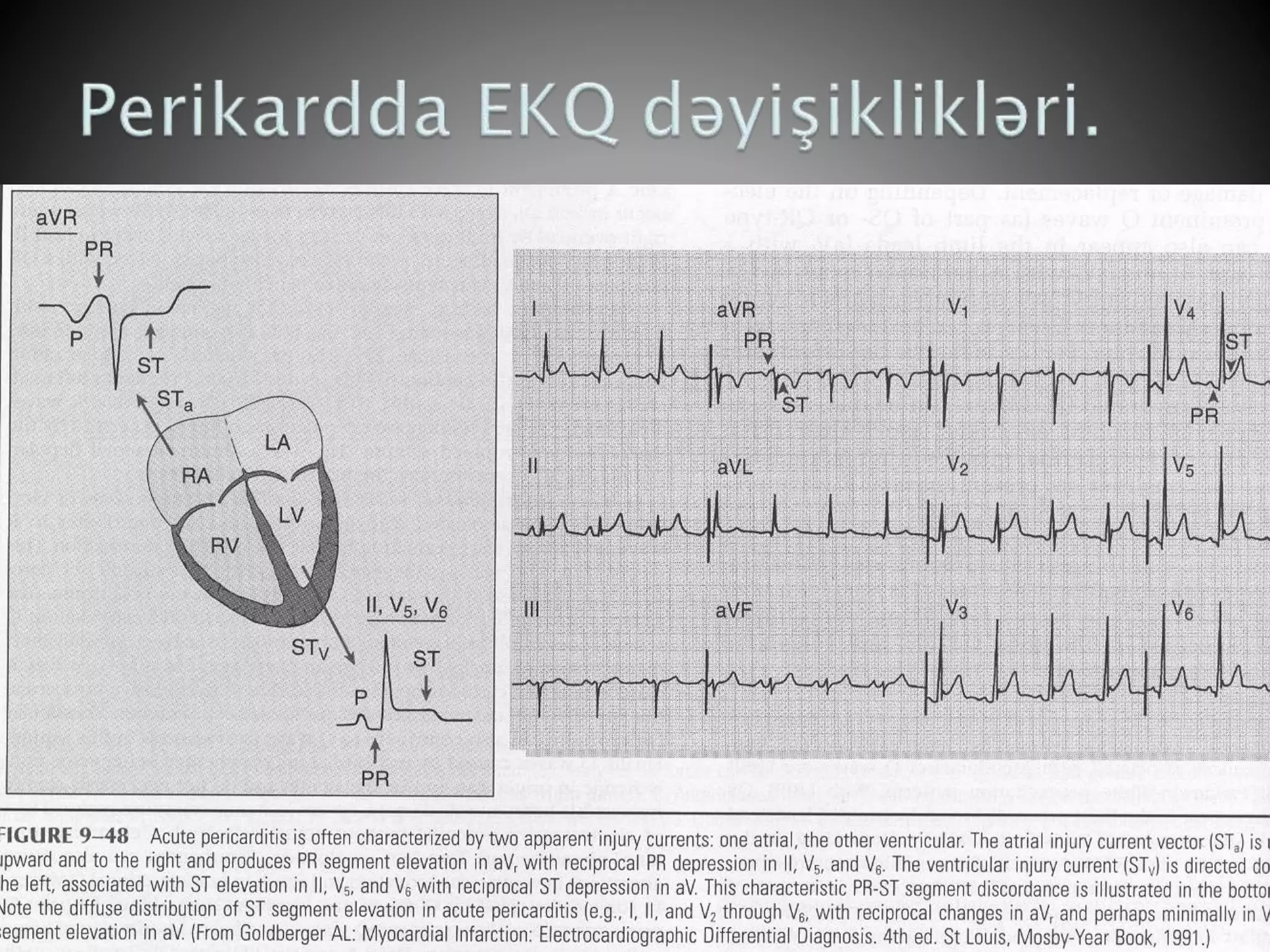 Miokard infarkti (Myocardia infarctus) | PPTX