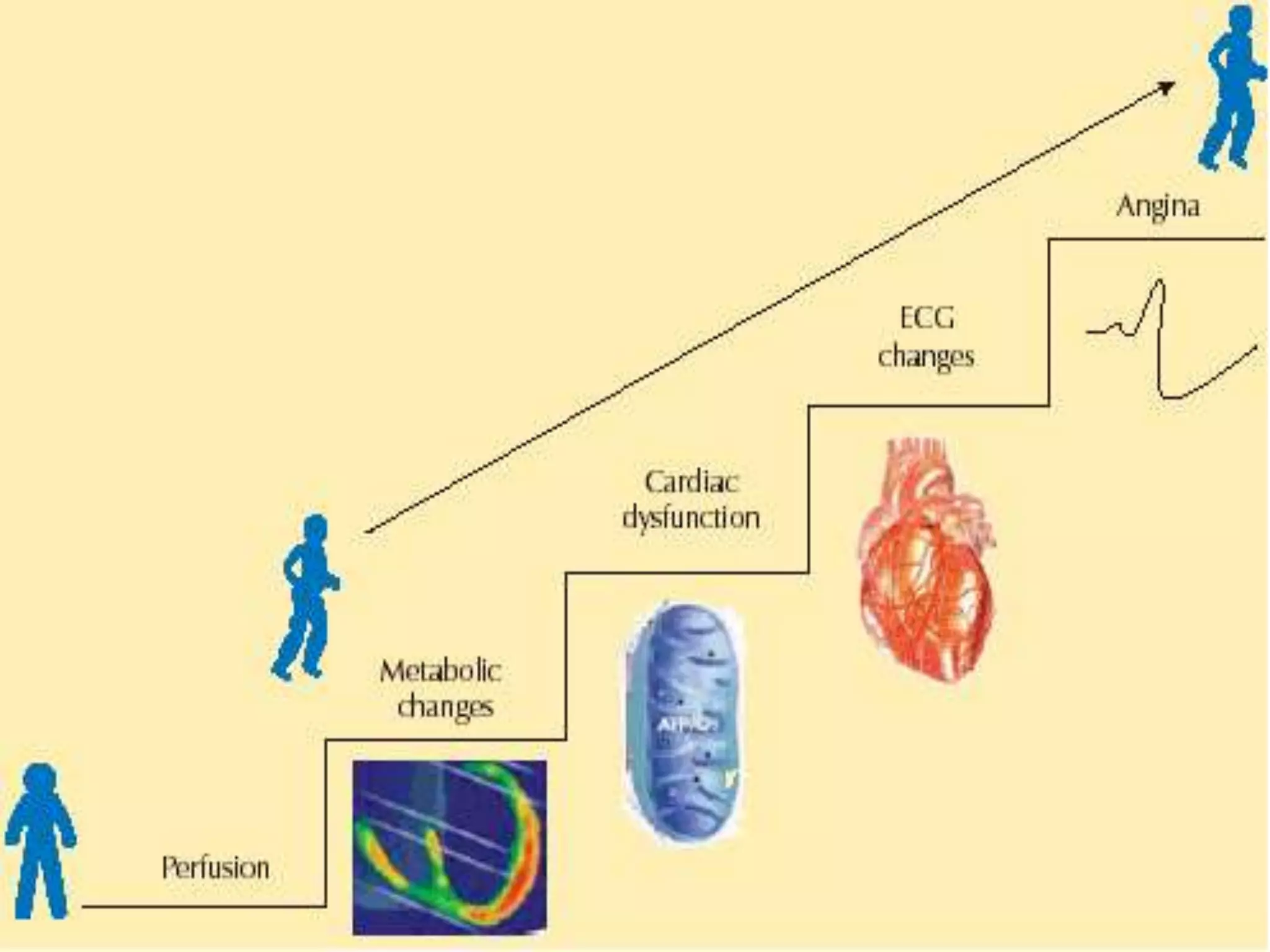 Miokard infarkti (Myocardia infarctus) | PPTX