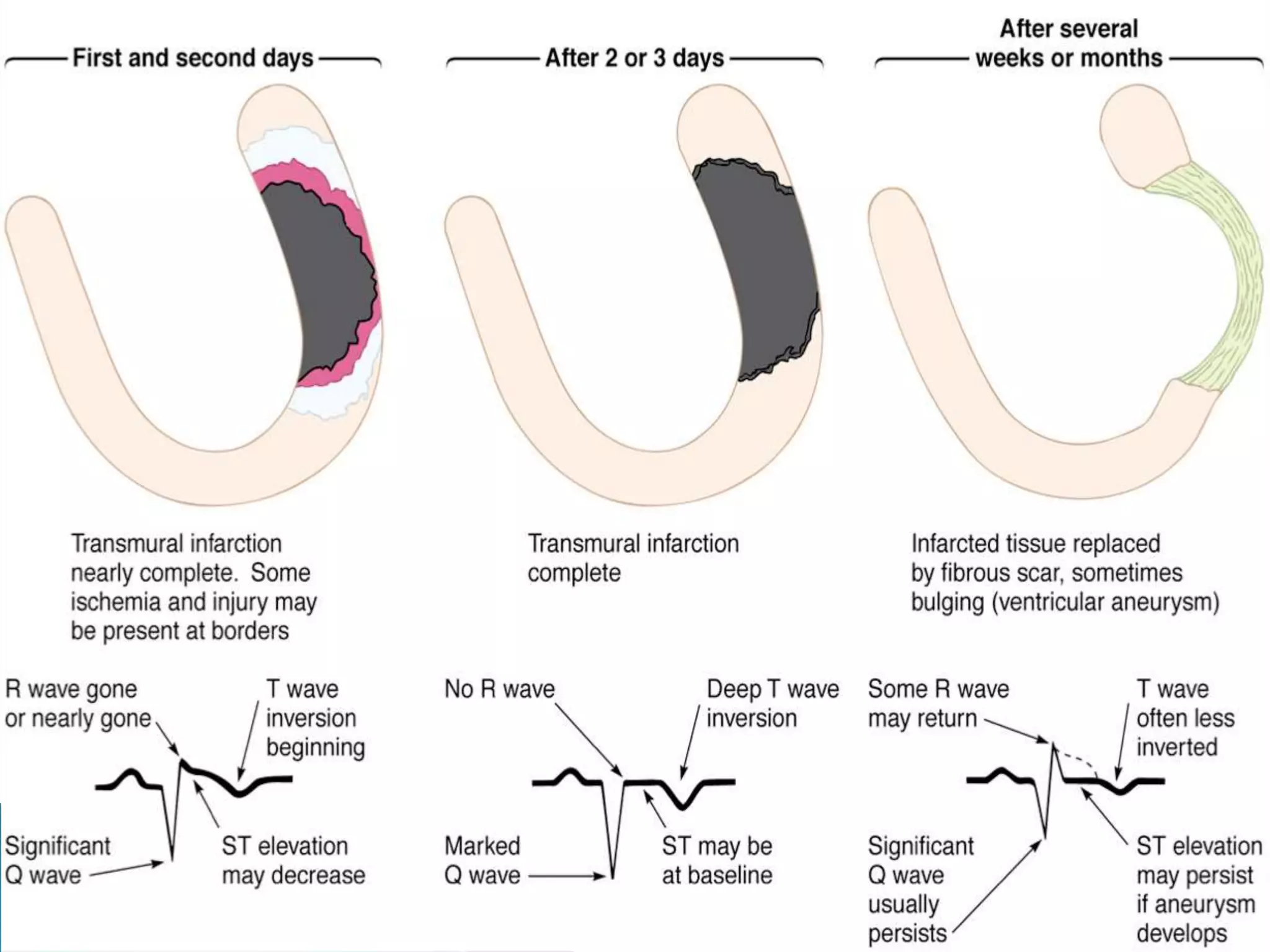 Miokard infarkti (Myocardia infarctus) | PPTX