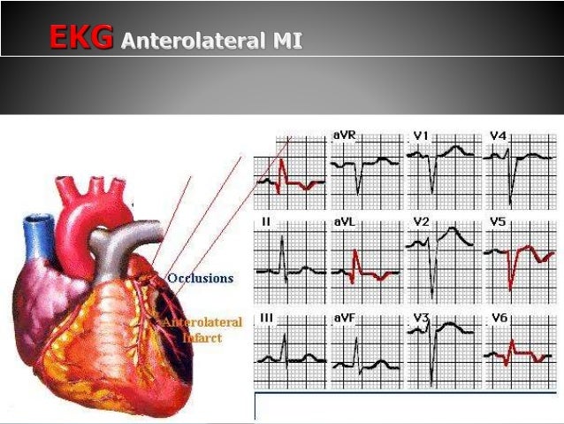Miokard infarkti (Myocardia infarctus)